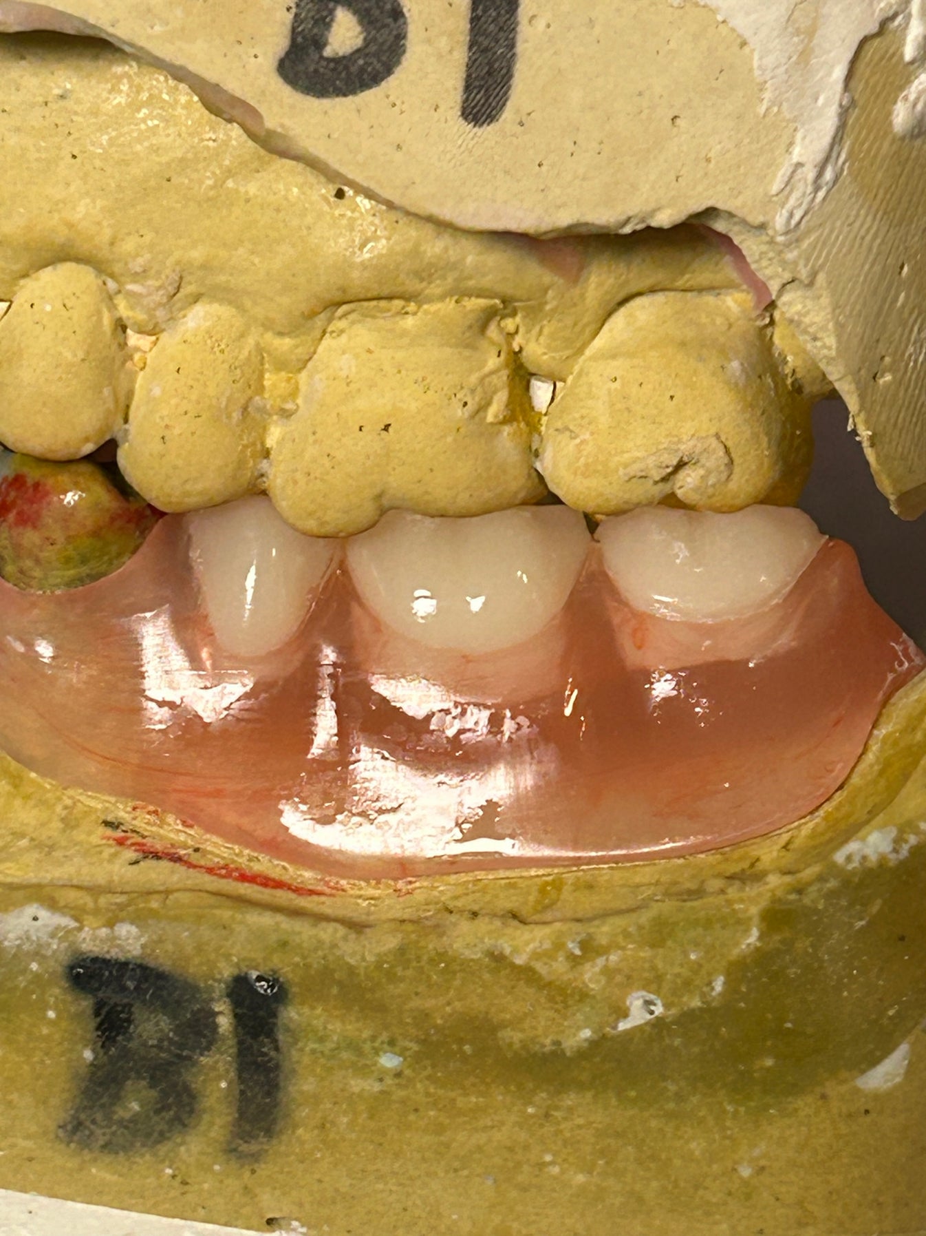 Flexible Nesbit – Dentures 4U